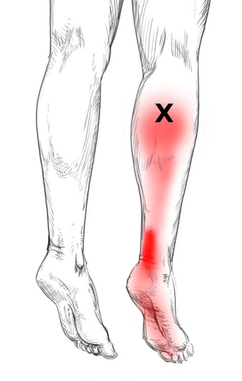 Músculo tibial posterior – Dolor y puntos gatillo