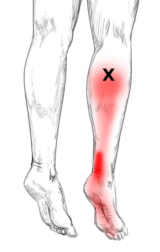 Músculo tibial posterior – Dolor y puntos gatillo