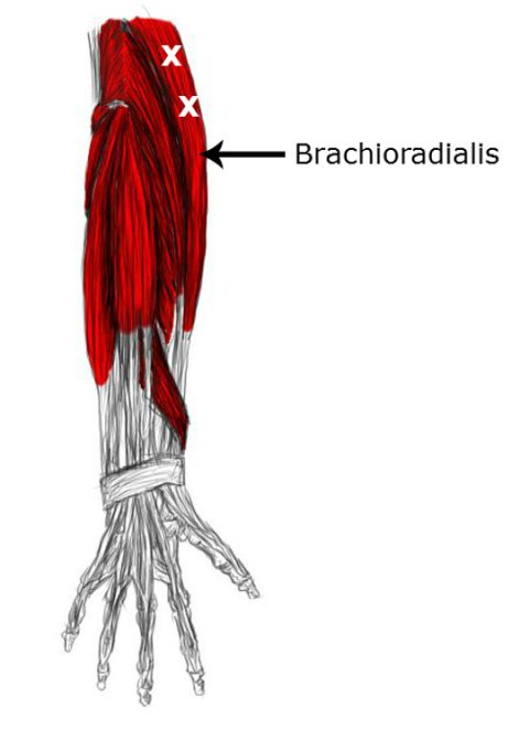 Músculo braquiorradial: Dolores y puntos gatillo