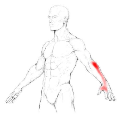 Músculo extensor radial largo del carpo: Dolores y puntos gatillo