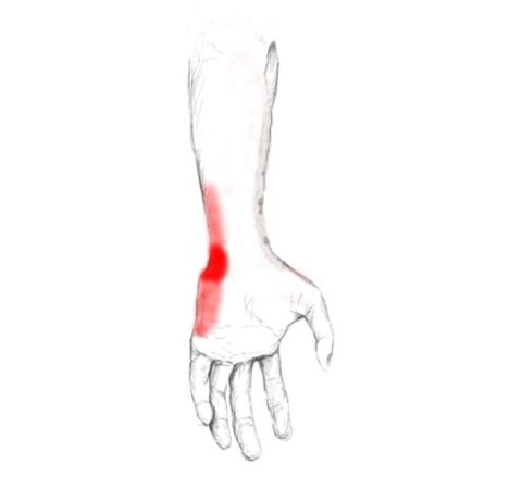 Músculo flexor cubital del carpo: Dolores y puntos gatillo