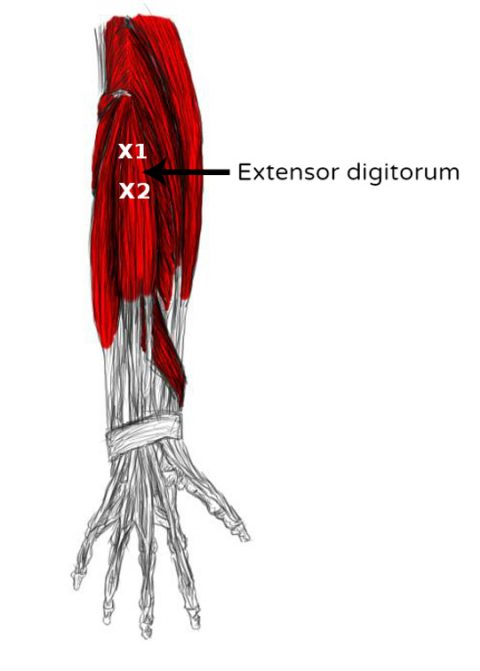 Músculo extensor común de los dedos: Dolores y punto gatillo
