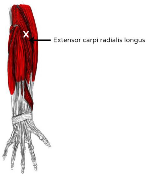 Músculo extensor radial largo del carpo: Dolores y puntos gatillo