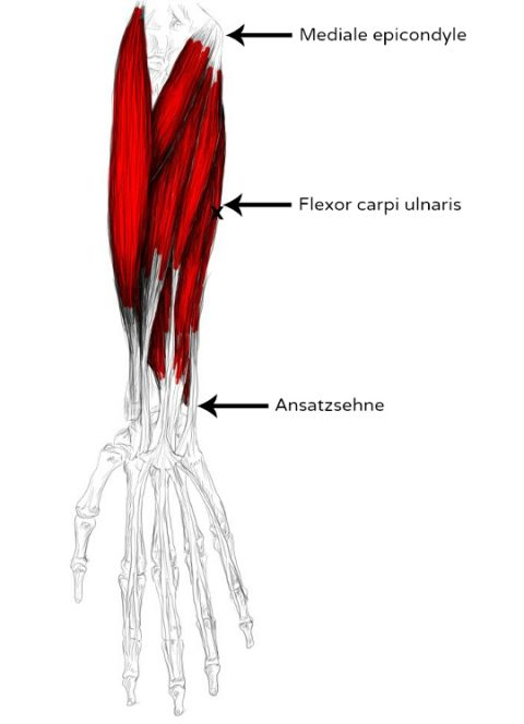 Músculo flexor cubital del carpo: Dolores y puntos gatillo