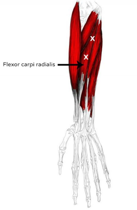 Músculo flexor radial del carpo: Dolores y puntos gatillo