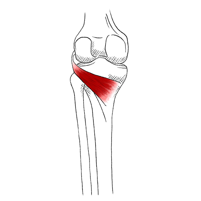 Músculo poplíteo – Dolor y puntos gatillo