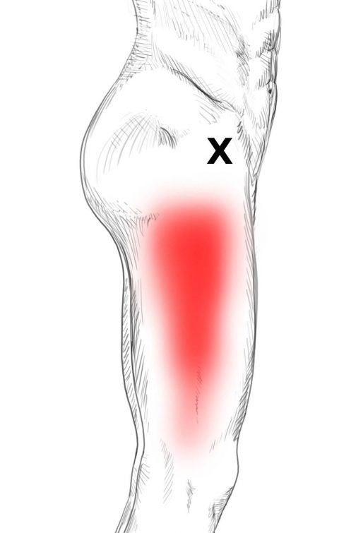 Tensor Fasciae Latae The Trigger Point Referred Pain Guide – eroppa